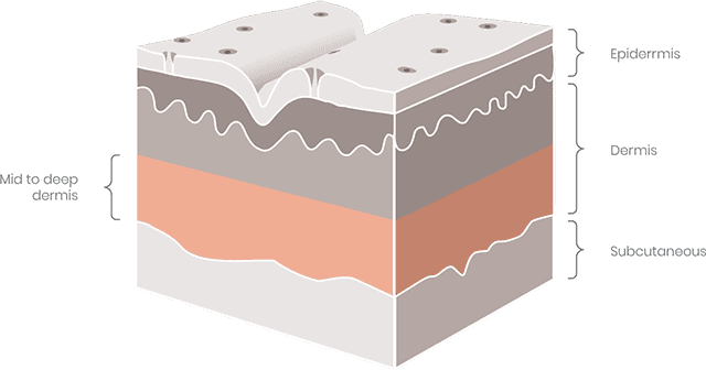 Dermal-Layers_InjectionDepth_Ultra - Swiss Clinics București